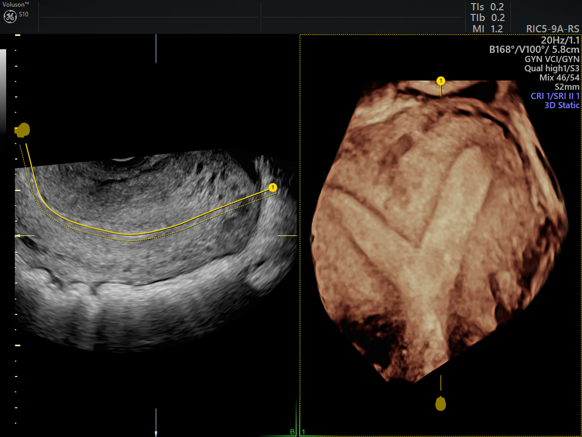 Uterine Malformation Better Diagnosis With 3d Ultrasound Empowered