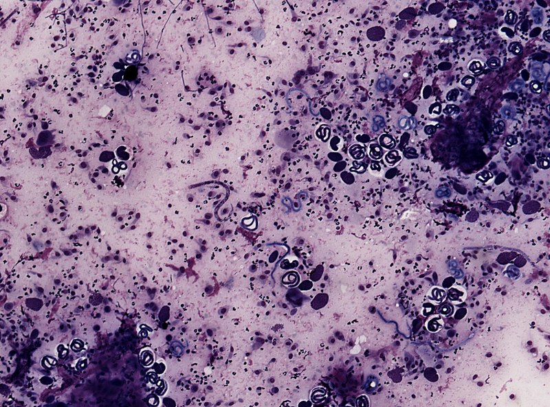 Researchers develop a better test for the parasite that causes river ...